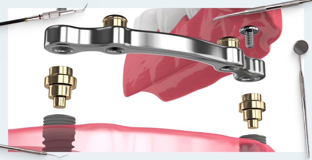 Screw-retained Vs. Cemented Restorations: Which Is Better?