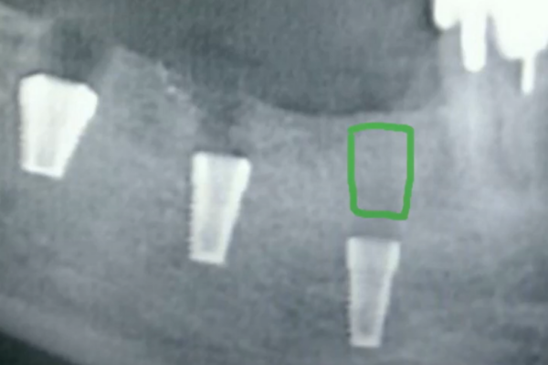 Implant Prosthetic Complications: Prevention Guide (Part 2)