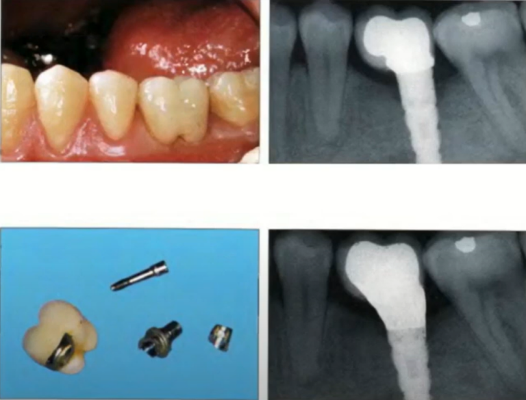 Implant Prosthetic Complications: Prevention Guide (Part 2)