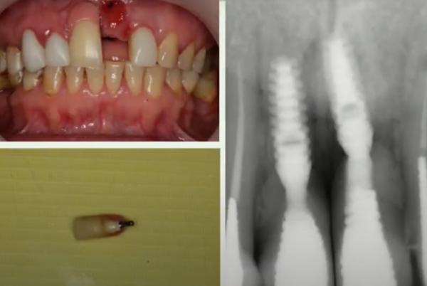 Implant Prosthetic Complications: Prevention Guide (Part 2)