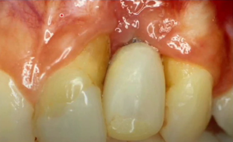 Implant Prosthetic Complications: Prevention Guide (Part 2)