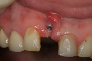 Implant Prosthetic Complications: Prevention Guide (Part 2)