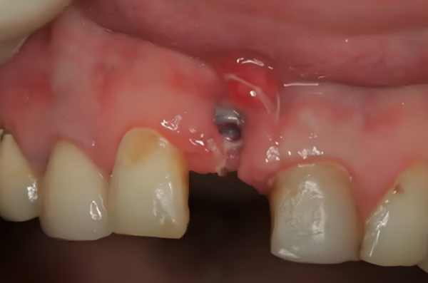 Implant Prosthetic Complications: Prevention Guide (Part 2)