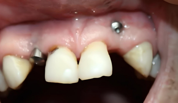 Implant Prosthetic Complications: Prevention Guide (Part 2)