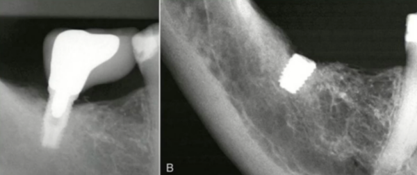 Implant Prosthetic Complications: Prevention Guide (Part 2)