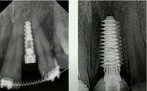 Implant Prosthetic Complications: Prevention Guide (Part 2)