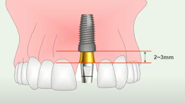 Implant Prosthetic Complications: Prevention Guide (Part 2)