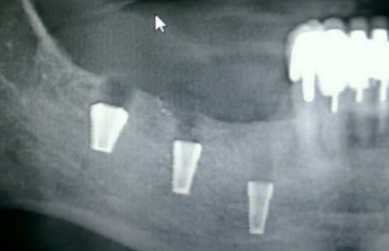 Implant Prosthetic Complications: Prevention Guide (Part 2)