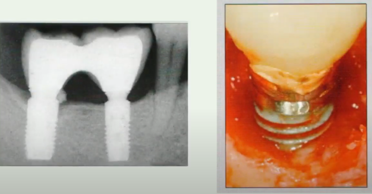 Implant Prosthetic Complications: Prevention Guide (Part 2)