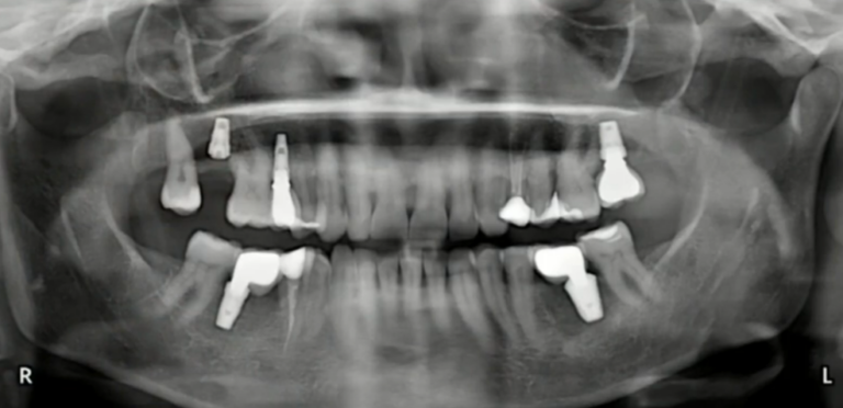 Implant Prosthetic Complications: Prevention Guide (Part 2)