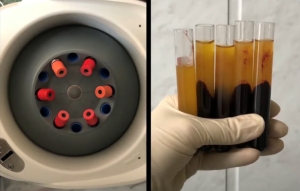 PRF Technique Procedures: 7-Day Healing Protocol For Doctors