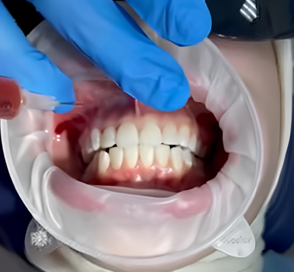 PRF Technique Procedures: 7-Day Healing Protocol For Doctors