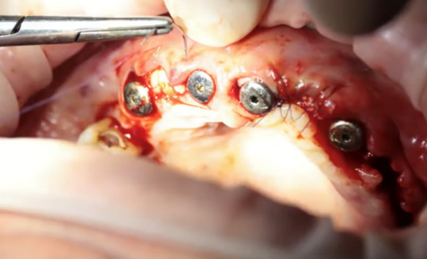 Clinical Guide: Gentle Implantation Without Bone Grafting [Cases]