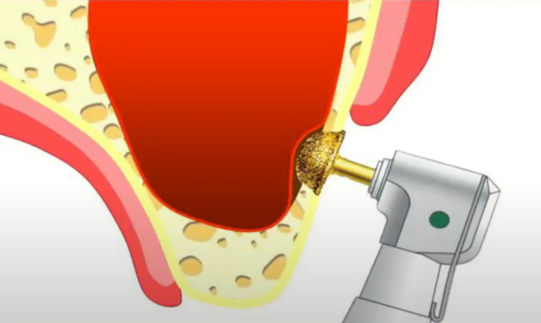 Dental Sinus Lift Surgery: Open & Closed Methods [Complete Guide]