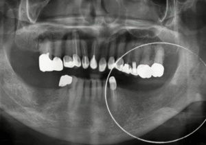 Ridge Split Technique: Implant Placement Protocol [Part 2]