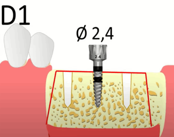 Ridge Split Technique: Implant Placement Protocol [Part 2]