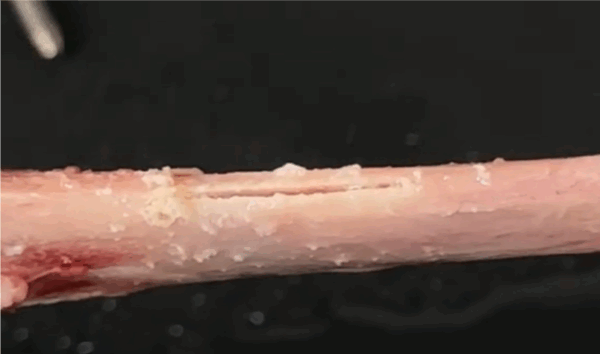 Ridge Split Technique: Implant Placement Protocol [Part 2]