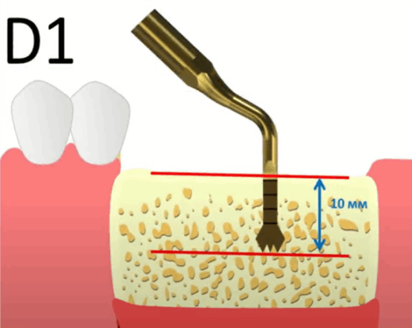 Ridge Split Technique: Implant Placement Protocol [Part 2]