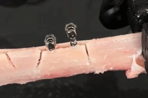 Ridge Split Technique: Implant Placement Protocol [Part 2]