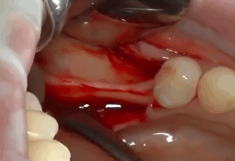 Ridge Split Technique: Implant Placement Protocol [Part 2]
