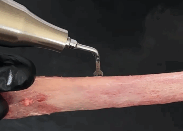 Ridge Split Technique: Implant Placement Protocol [Part 2]