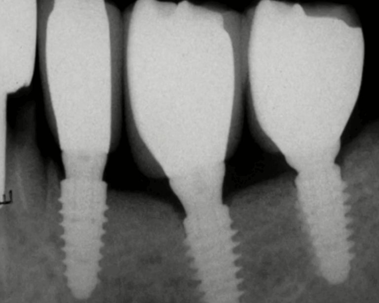Ridge Split Technique: Implant Placement Protocol [Part 2]