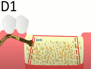 Ridge Split Technique: Implant Placement Protocol [Part 2]