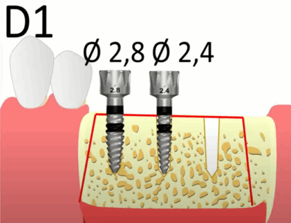 Ridge Split Technique: Implant Placement Protocol [Part 2]