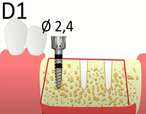 Ridge Split Technique: Implant Placement Protocol [Part 2]