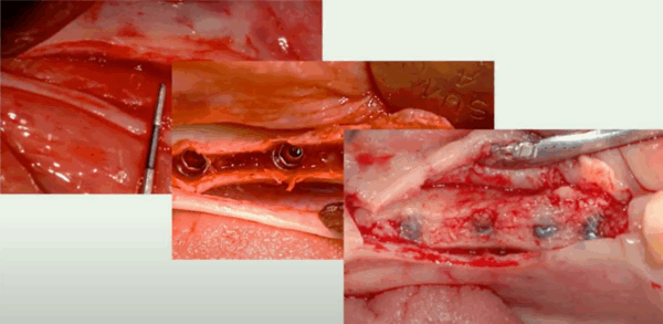 Ridge Split Technique: Implant Placement Protocol [Part 2]