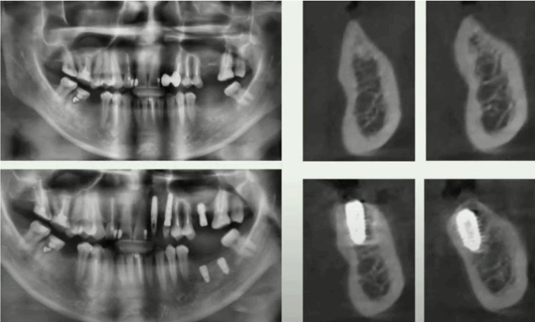 Ridge Split Technique: Implant Placement Protocol [Part 2]
