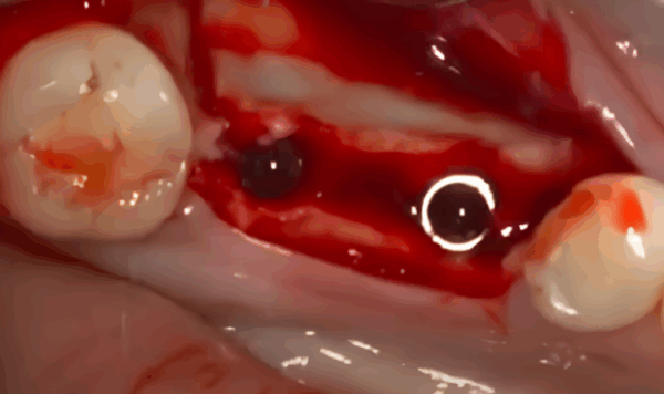 Ridge Split Technique: Implant Placement Protocol [Part 2]