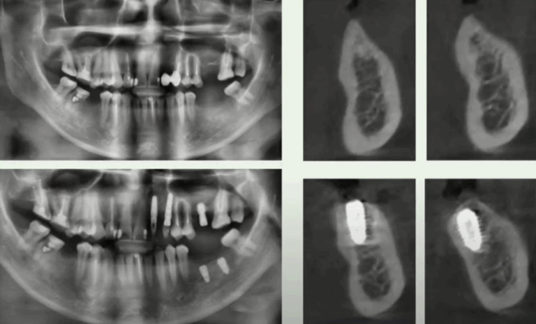 Ridge Split Technique: Implant Placement Protocol [Part 2]