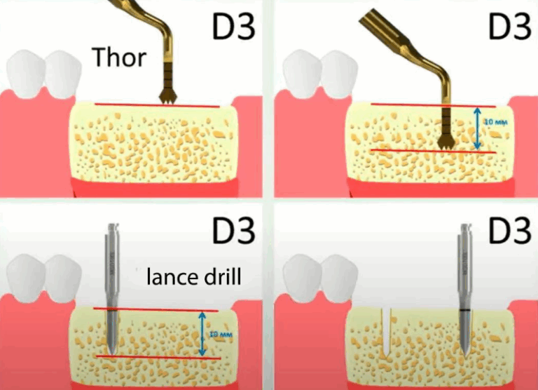 Ridge Split Technique: Implant Placement Protocol [Part 2]