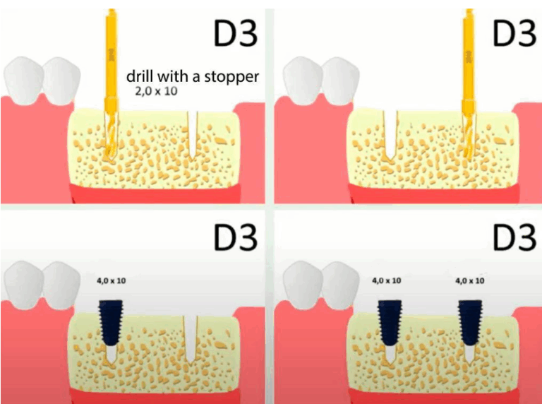 Ridge Split Technique: Implant Placement Protocol [Part 2]