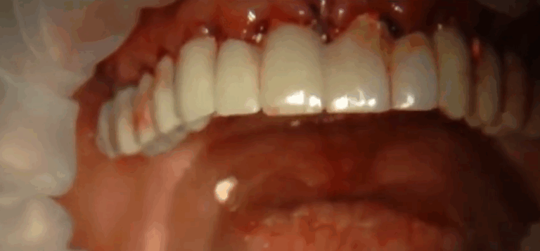 Implant Surgical Guides: A Clinical Guide For Doctors