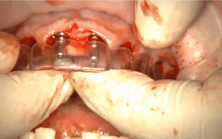 Implant Surgical Guides: A Clinical Guide For Doctors