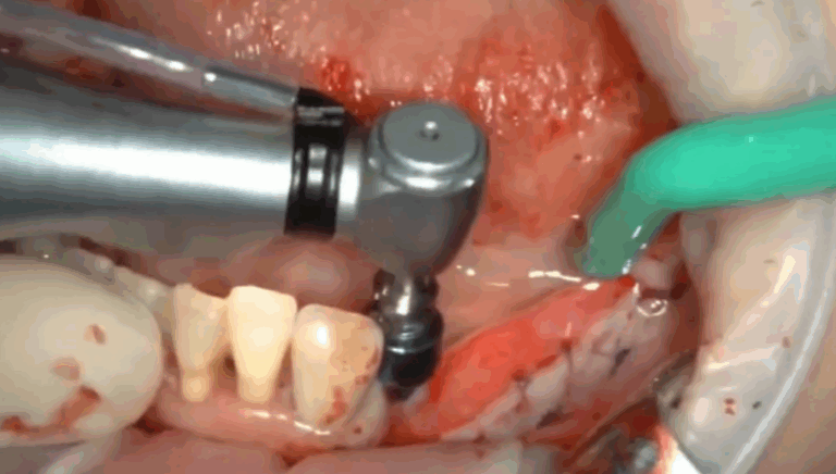 Implant Surgical Guides: A Clinical Guide For Doctors