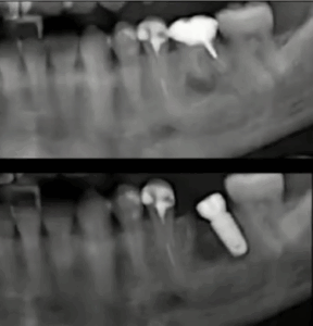 Implant System Selection And Immediate Loading Techniques