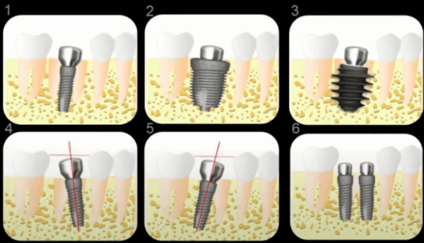Implant System Selection And Immediate Loading Techniques