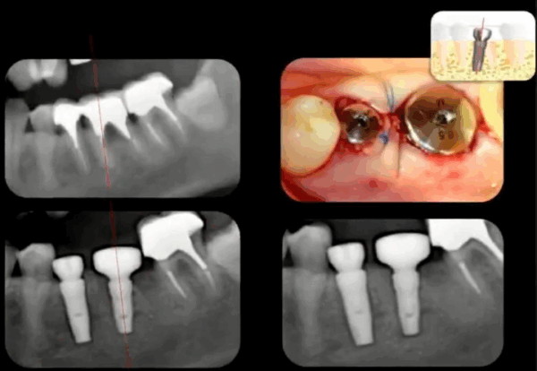 Implant System Selection And Immediate Loading Techniques