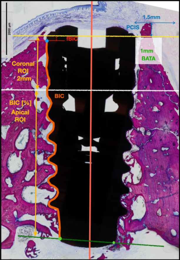 Osseointegration Without Primary Stability: 82% Bone Contact