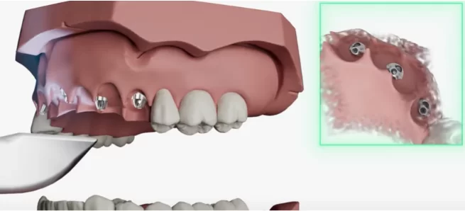 Full-Arch Dental Implants: Protocols And Advanced Techniques