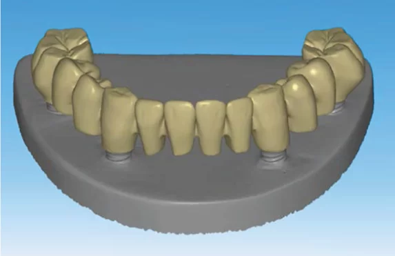 Full-Arch Dental Implants: Protocols And Advanced Techniques