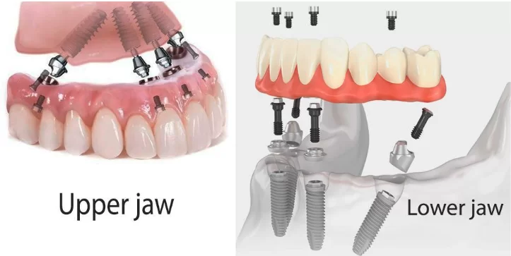 Full-Arch Dental Implants: Protocols And Advanced Techniques